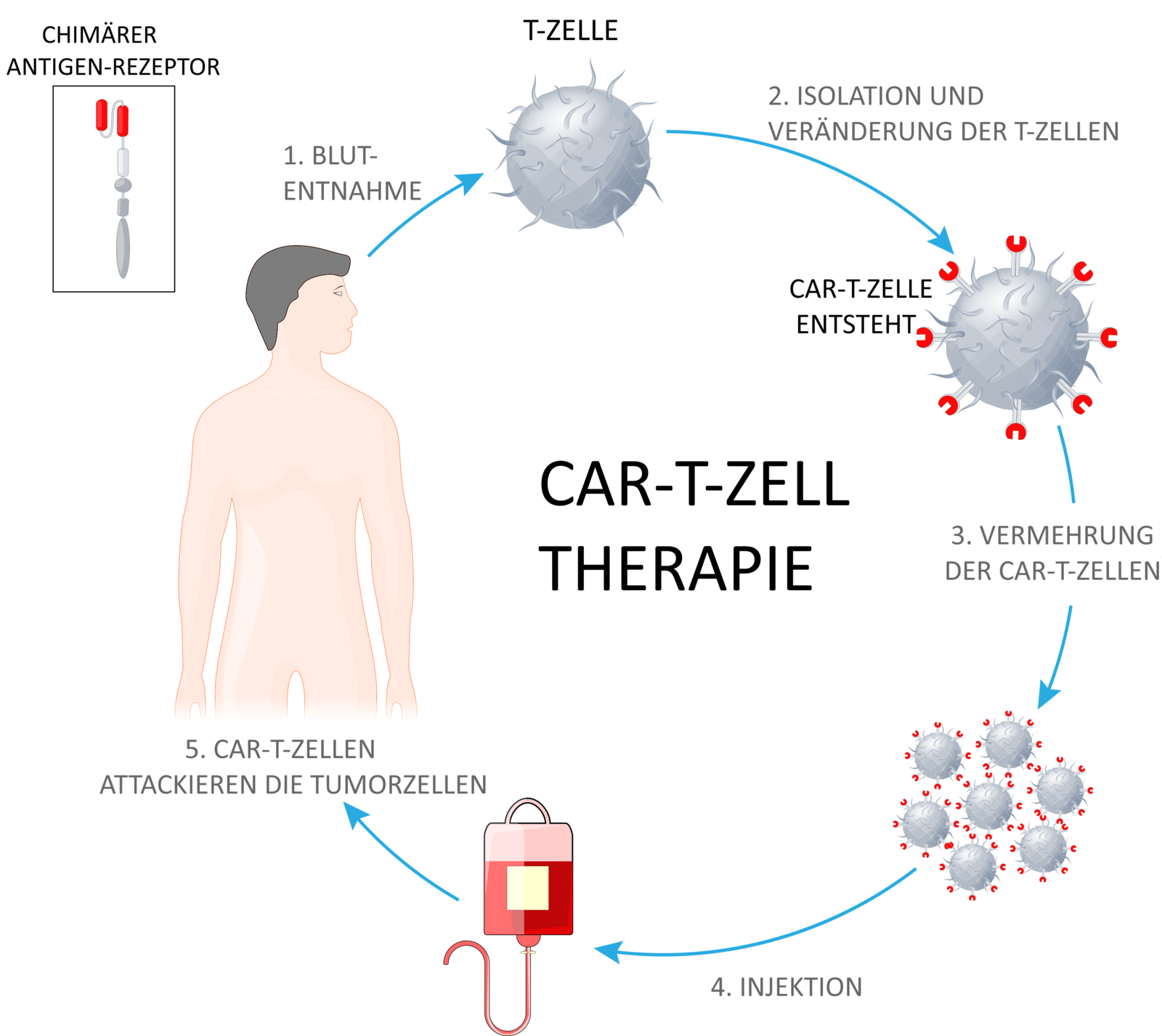 Wie läuft eine CAR-T-Zelltherapie ab? | CAR-T-Zell Therapie